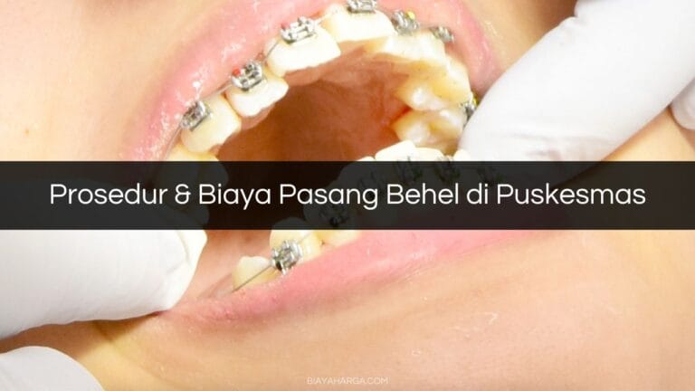 √ Prosedur & Biaya Pasang Behel di Puskesmas 2023 – Harga Biaya