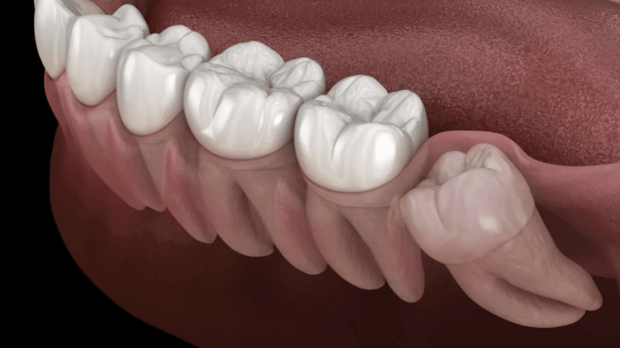 √ Biaya Cabut Gigi Geraham Bungsu di Puskesmas 2023 – Harga Biaya
