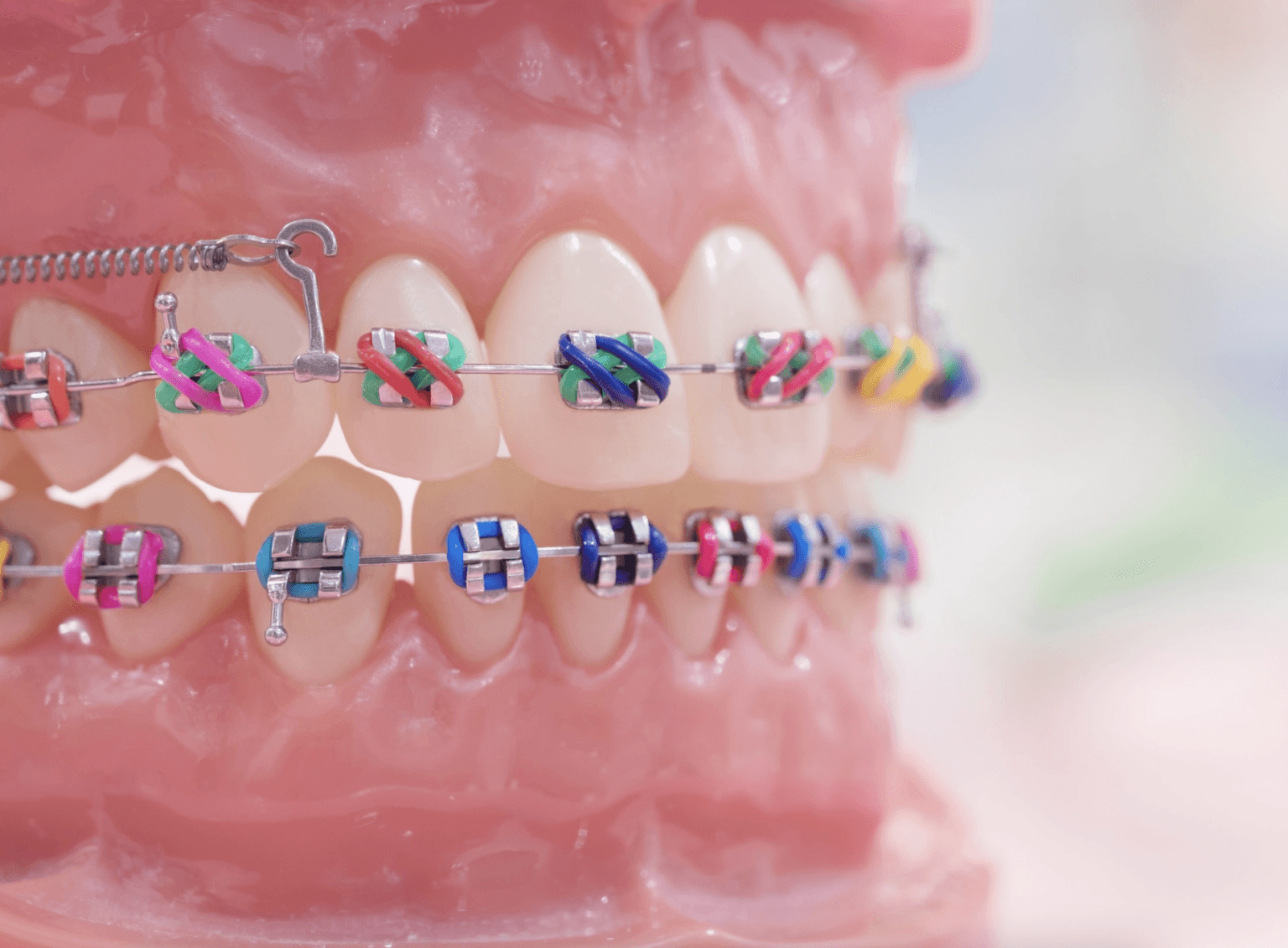 √ Prosedur & Biaya Pasang Behel di Dokter Gigi 2023 – Harga Biaya