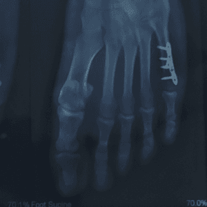 √ Prosedur & Biaya Rontgen Kaki di Klinik Prodia 2023 – Harga Biaya