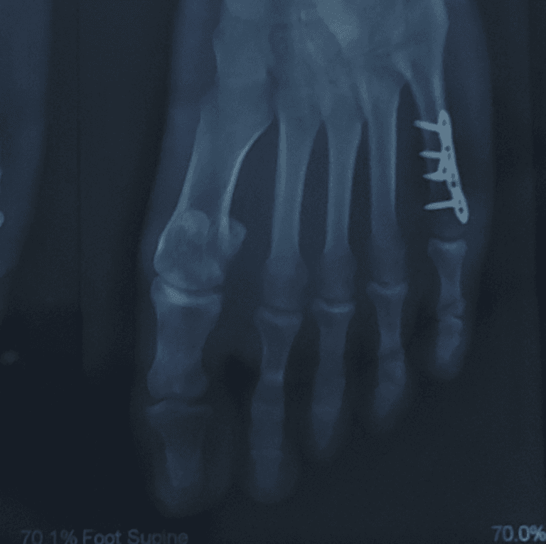 √ Prosedur & Biaya Rontgen Kaki di Klinik Prodia 2023 – Harga Biaya