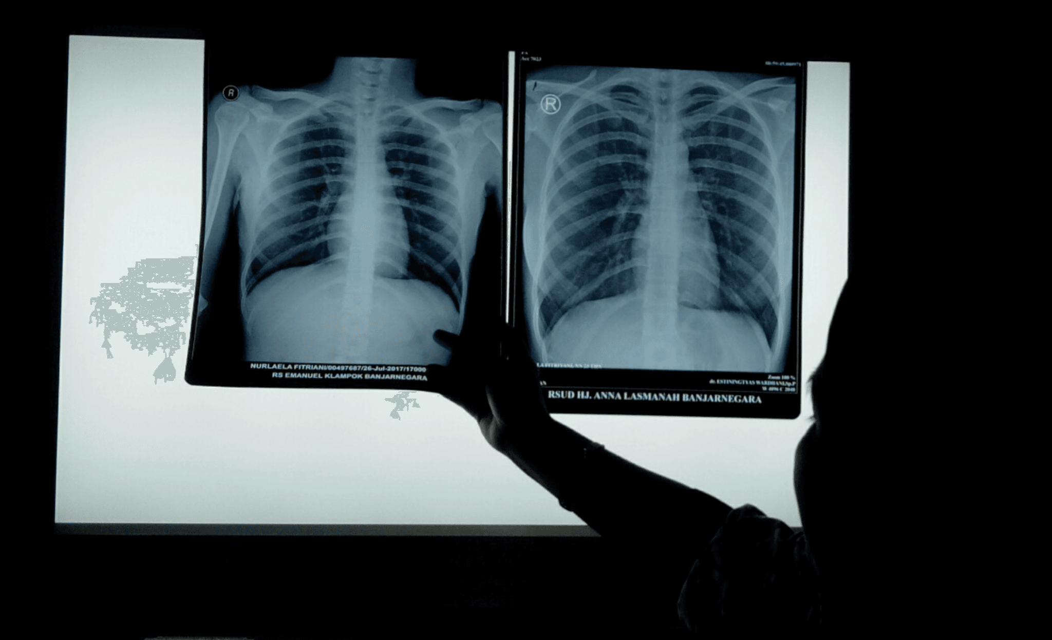 √ Biaya Rontgen Thorax di Laboratorium Klinik Prodia 2023 – Harga Biaya