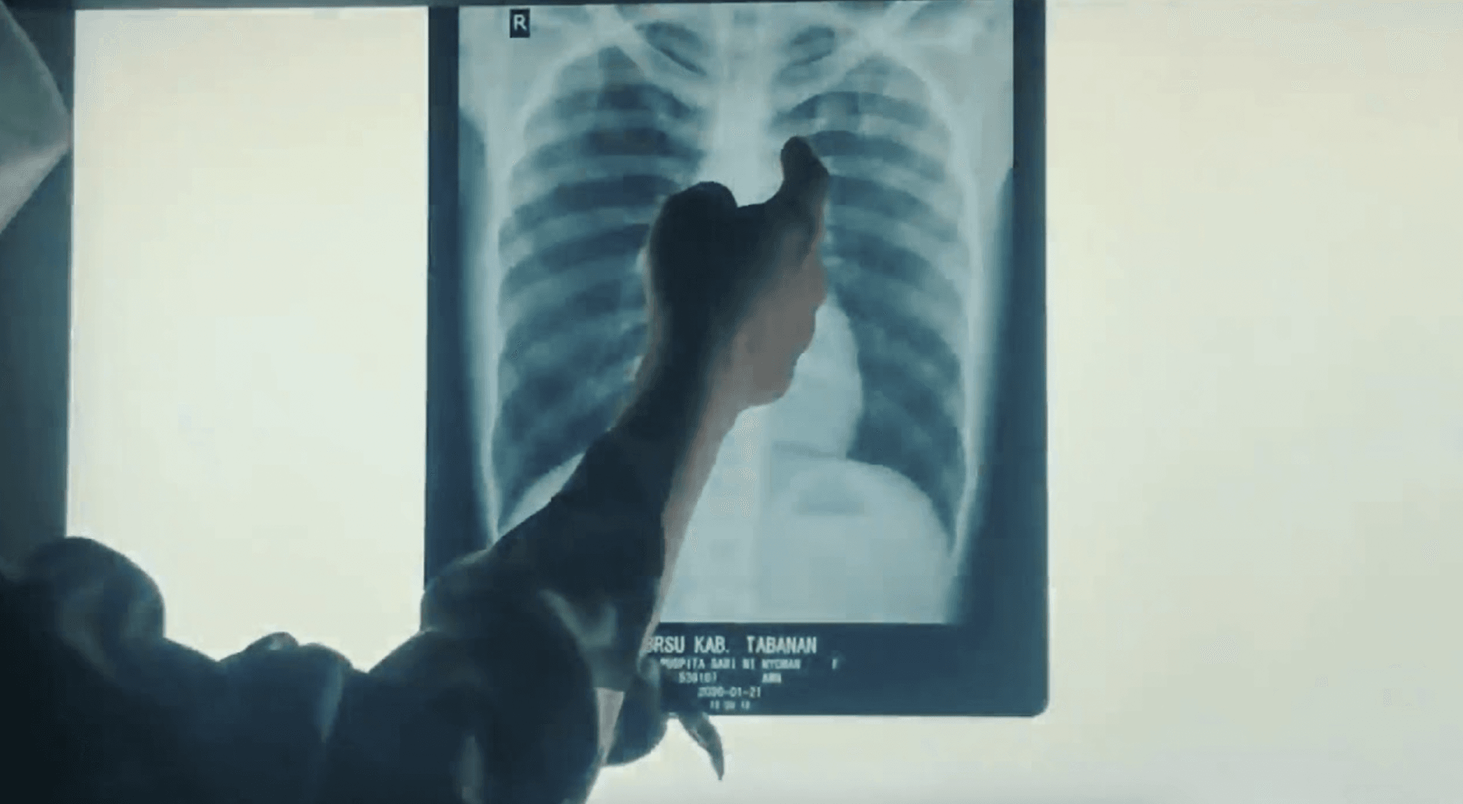 √ Biaya Rontgen Thorax di Laboratorium Klinik Prodia 2023 – Harga Biaya