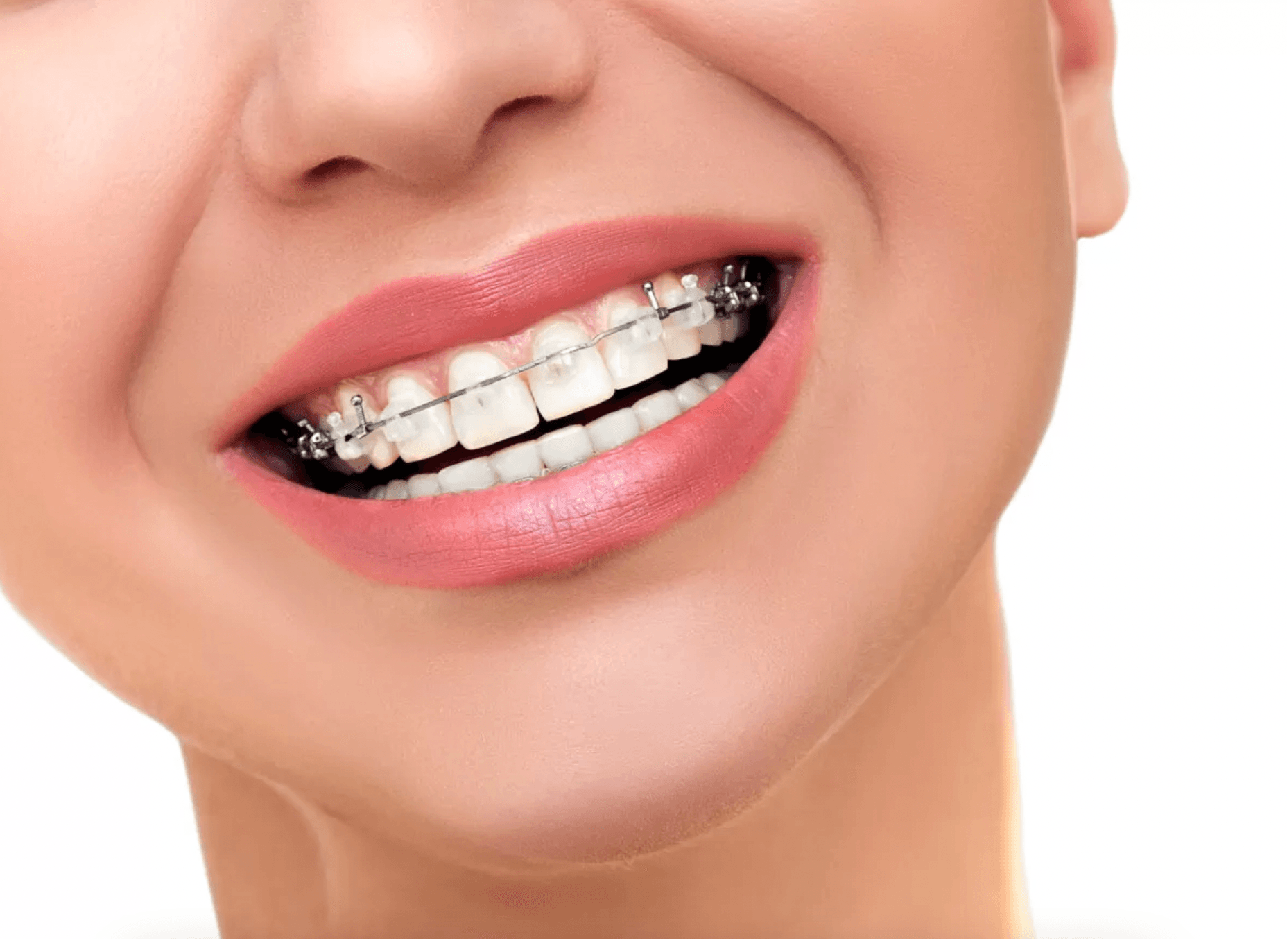 √ Prosedur & Biaya Pasang Behel di Dokter Gigi 2023 – Harga Biaya