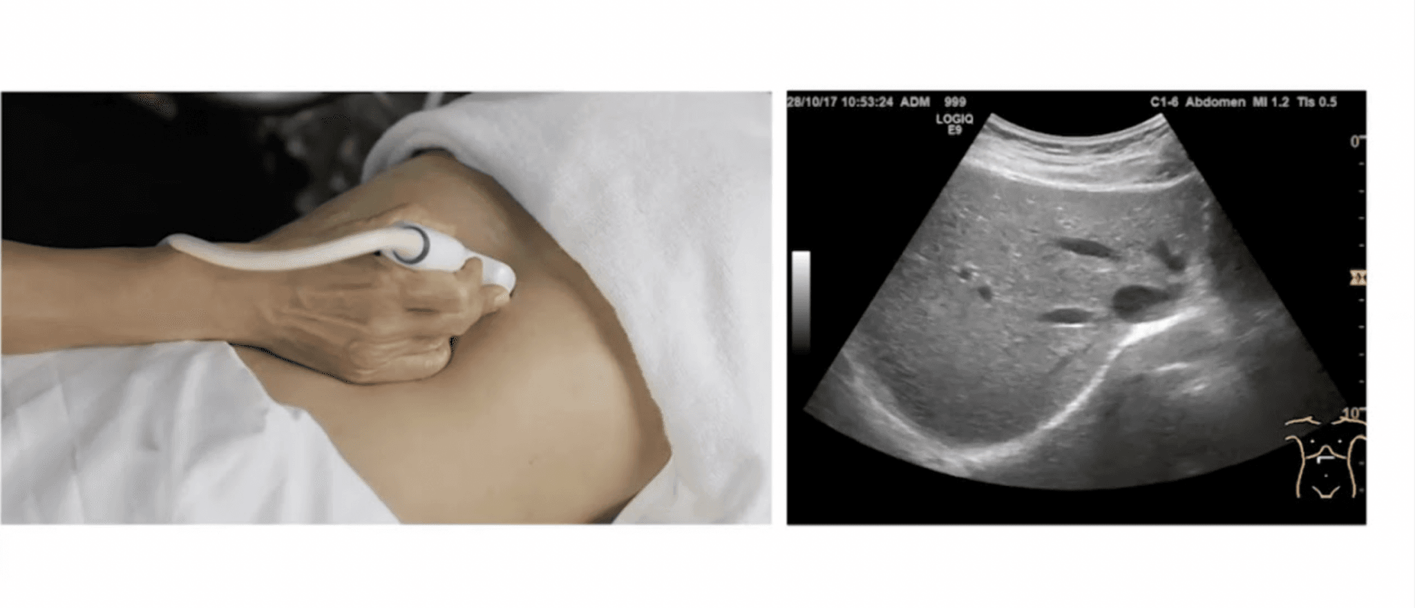 √ Prosedur & Biaya USG Abdomen di Lab Pramita 2023 – Harga Biaya