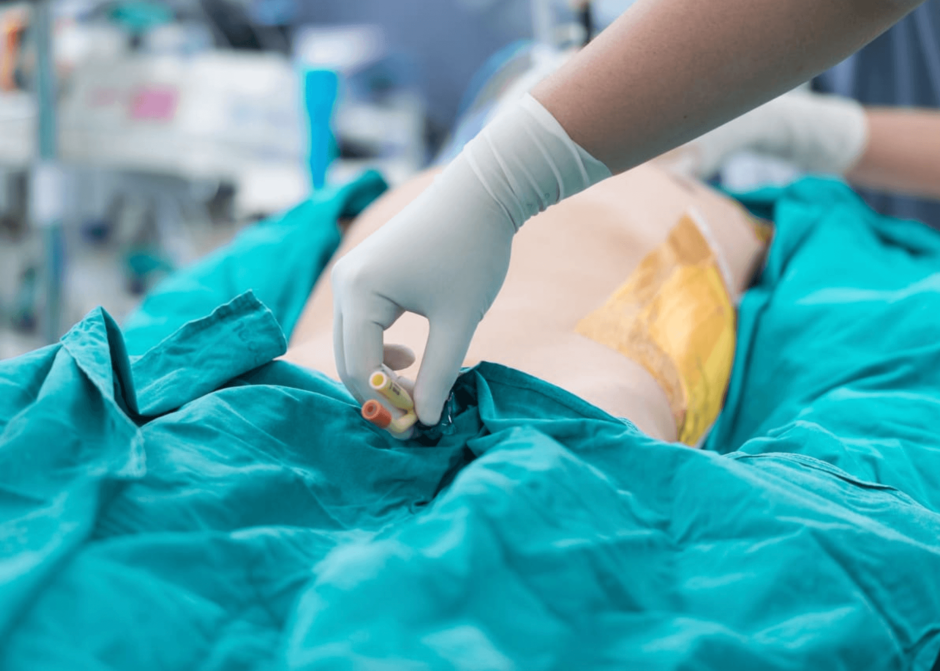 √ 4 Biaya Pasang Kateter Urine 2023 : Prosedur & Efek Samping – Harga Biaya