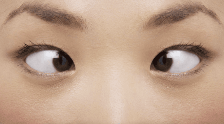 √ Biaya Operasi Mata Juling 2023 : Pasien Umum & BPJS – Harga Biaya